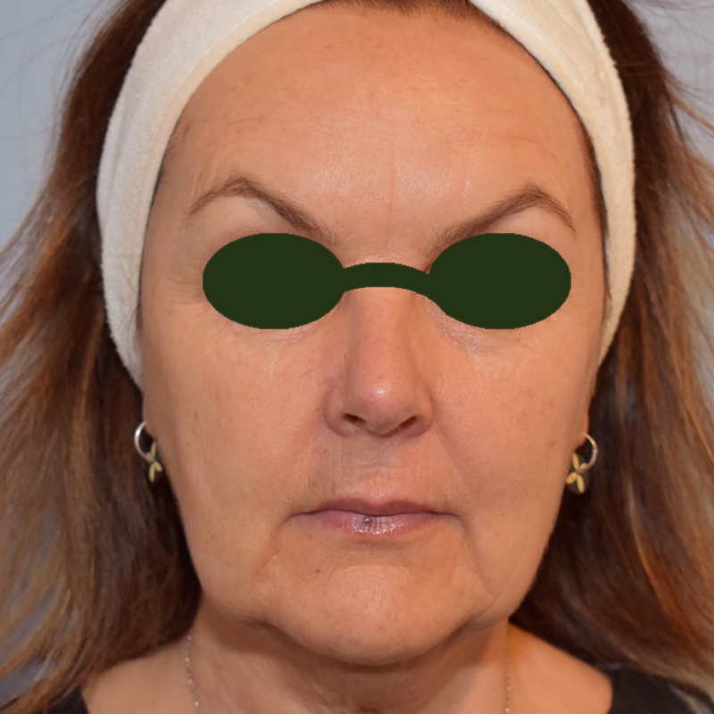 Koru Clinic | MINT Non-Surgical Thread Lift